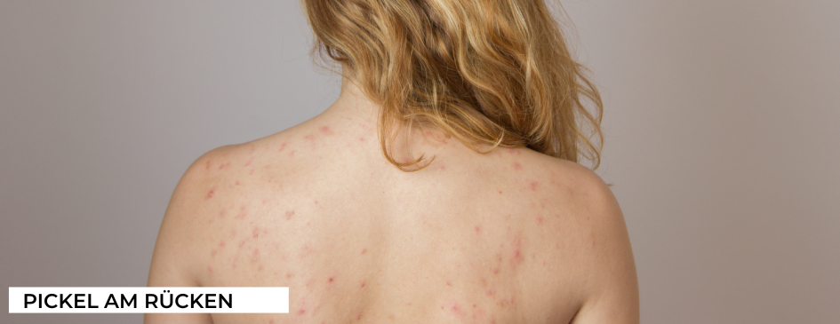 Pickel am Rücken mit CMD Naturkosmetik loswerden
